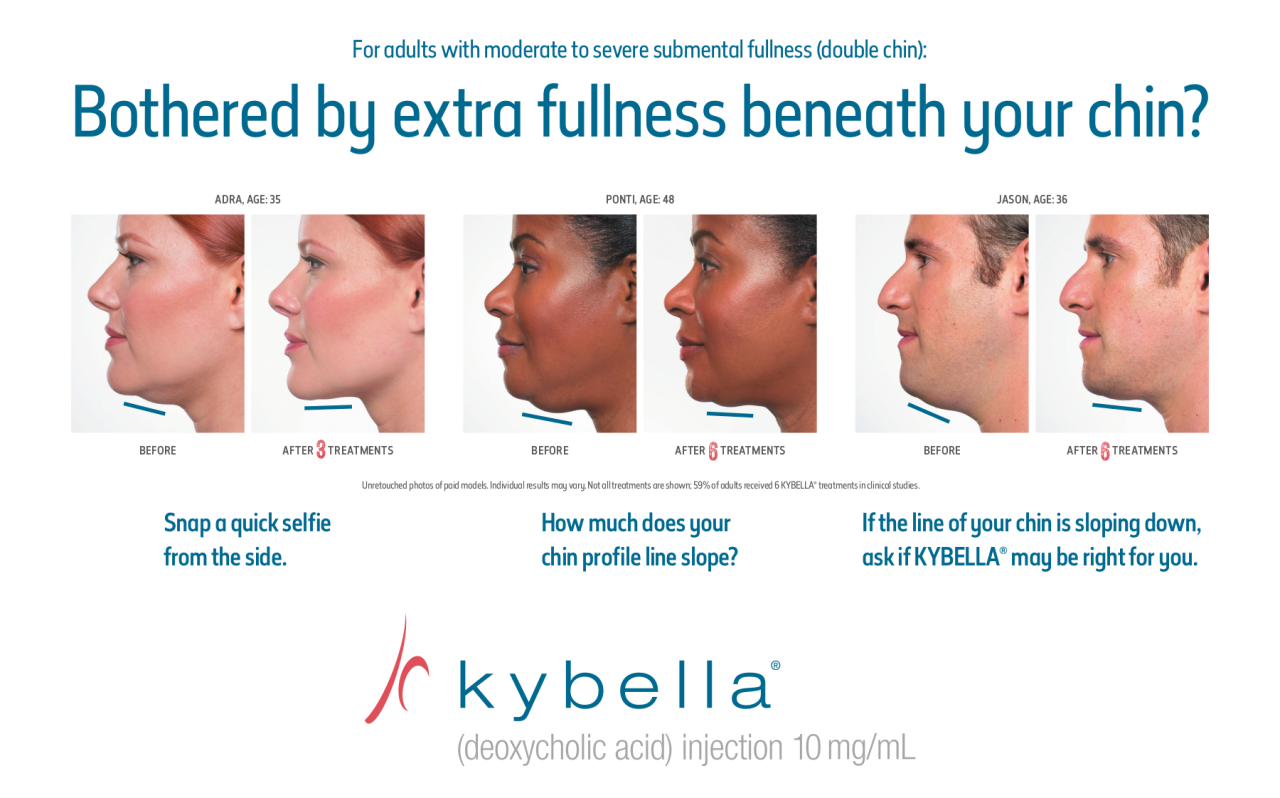 Kybella® in Bellevue | Advanced Skin & Body Solutions