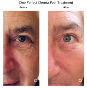 The Perfect Derma™ Peel | Advanced Skin & Body Solutions