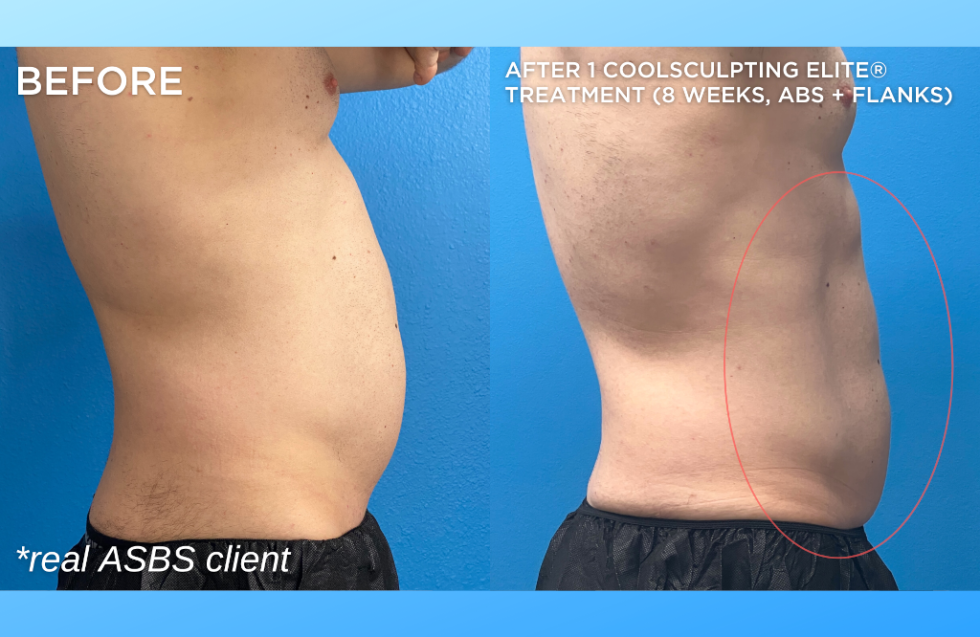 CoolSculpting® for Men | Advanced Skin & Body Solutions