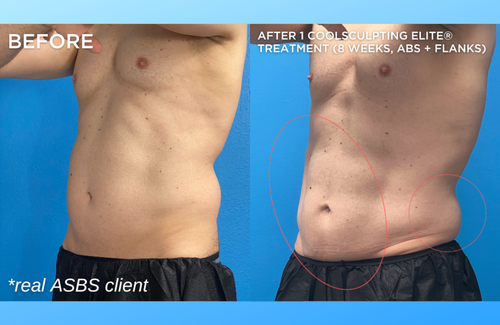 CoolSculpting® for Men | Advanced Skin & Body Solutions
