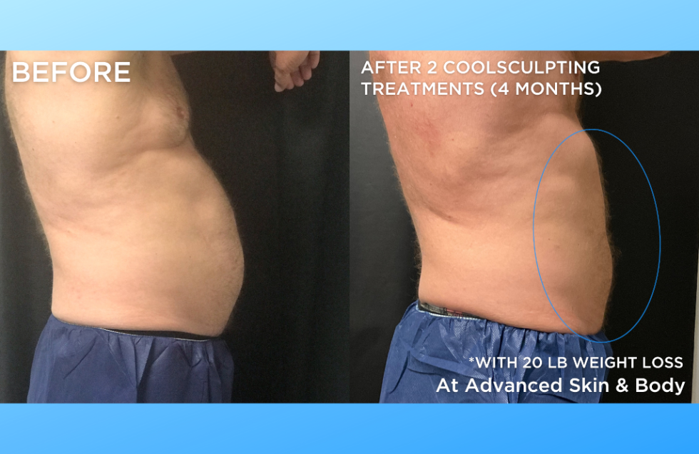 CoolSculpting® for Men | Advanced Skin & Body Solutions