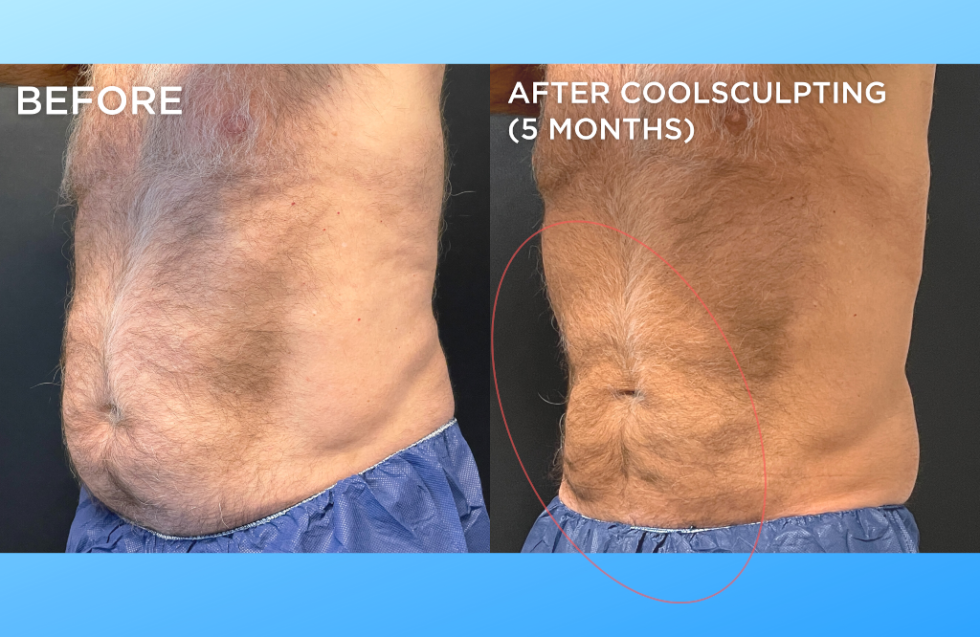 CoolSculpting® for Men | Advanced Skin & Body Solutions