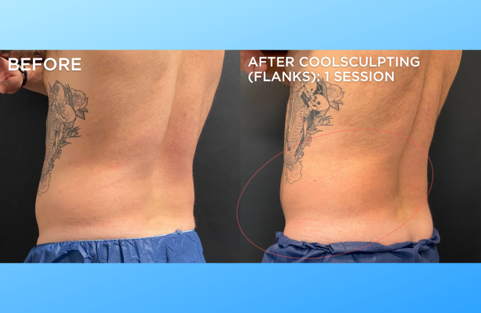 CoolSculpting® for Men | Advanced Skin & Body Solutions