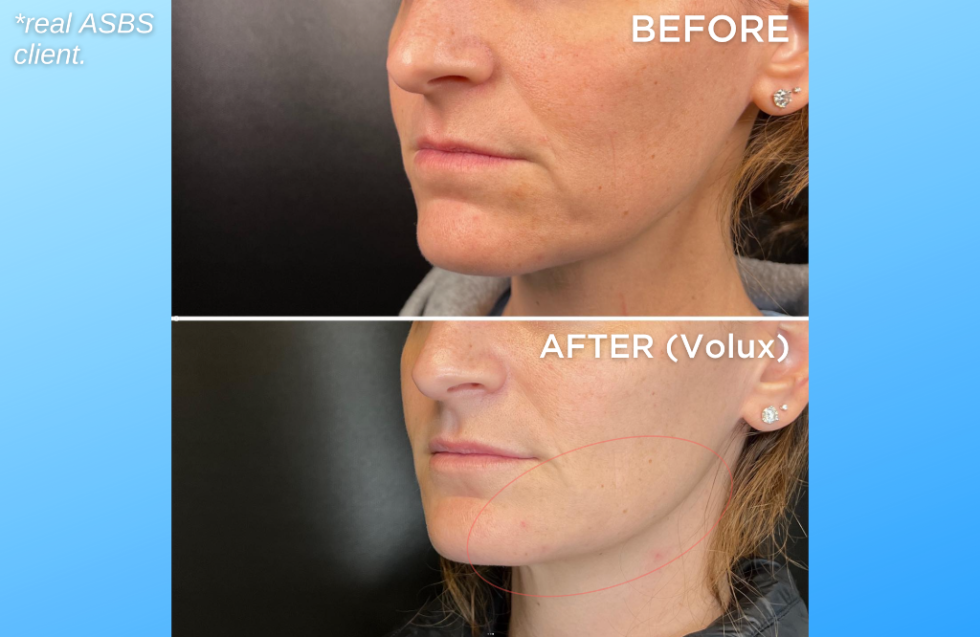 Juvéderm VOLUX® (Jaw)