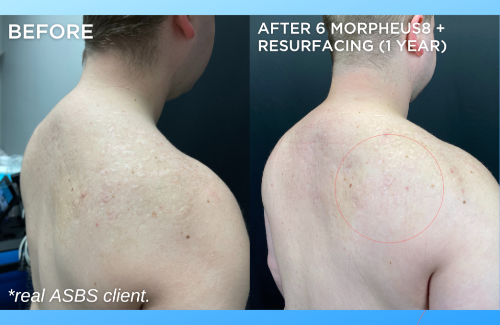 Morpheus8: Skin Tightening | Advanced Skin & Body Solutions