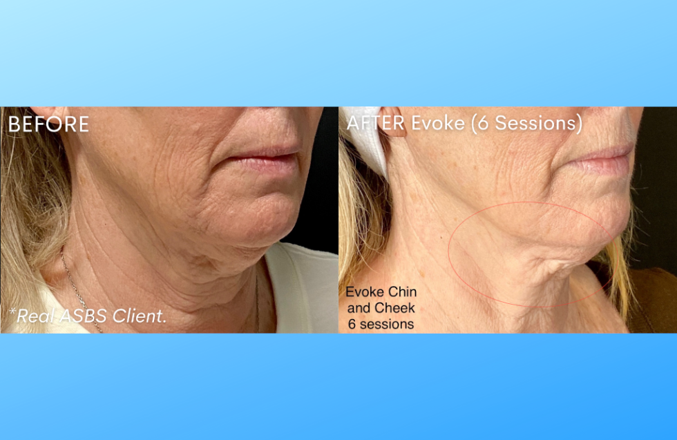 Evoke: Facial Contour | Advanced Skin & Body Solutions