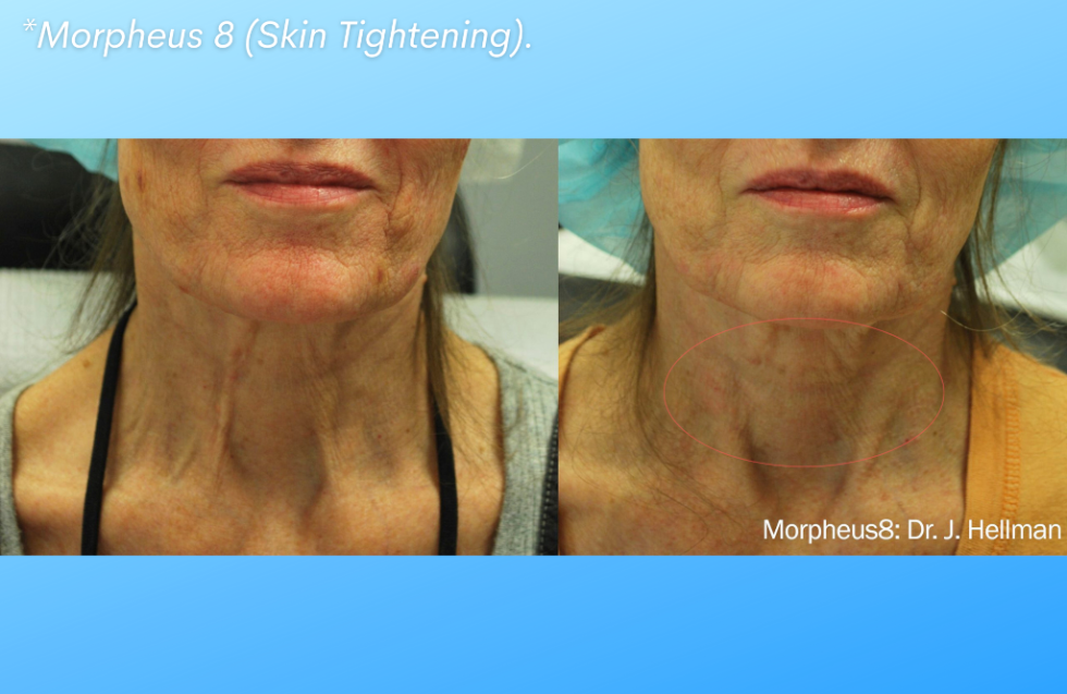 Morpheus8: Skin Tightening | Advanced Skin & Body Solutions