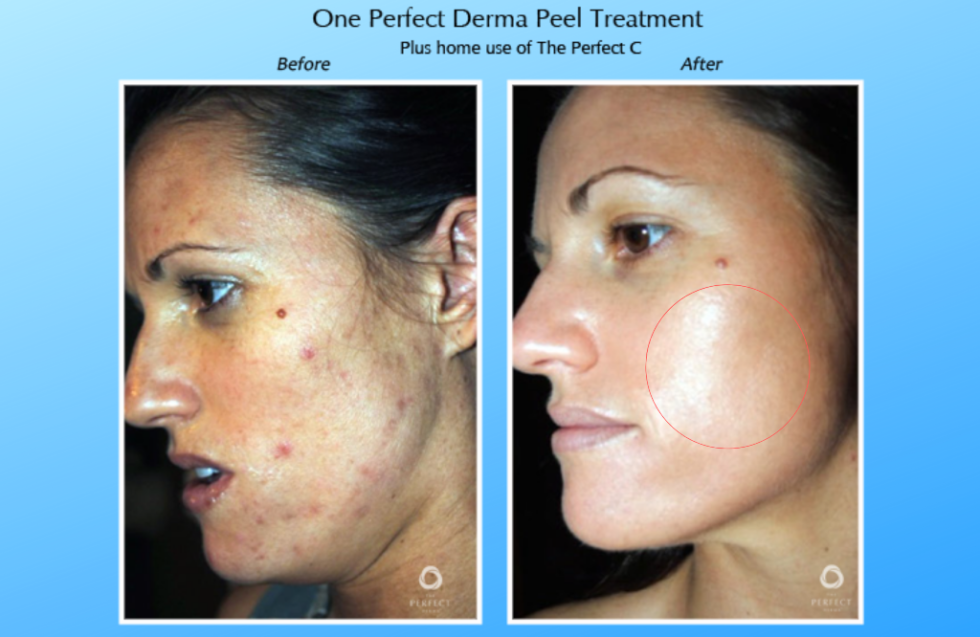 The Perfect Derma™ Peel | Advanced Skin & Body Solutions