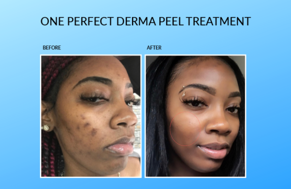 The Perfect Derma™ Peel | Advanced Skin & Body Solutions