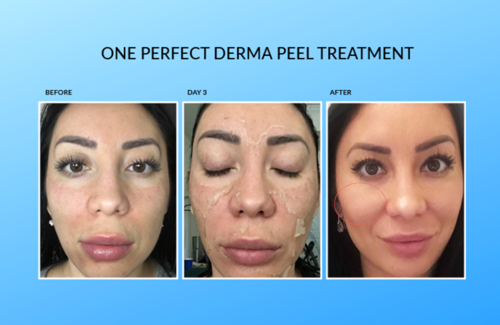 The Perfect Derma™ Peel | Advanced Skin & Body Solutions
