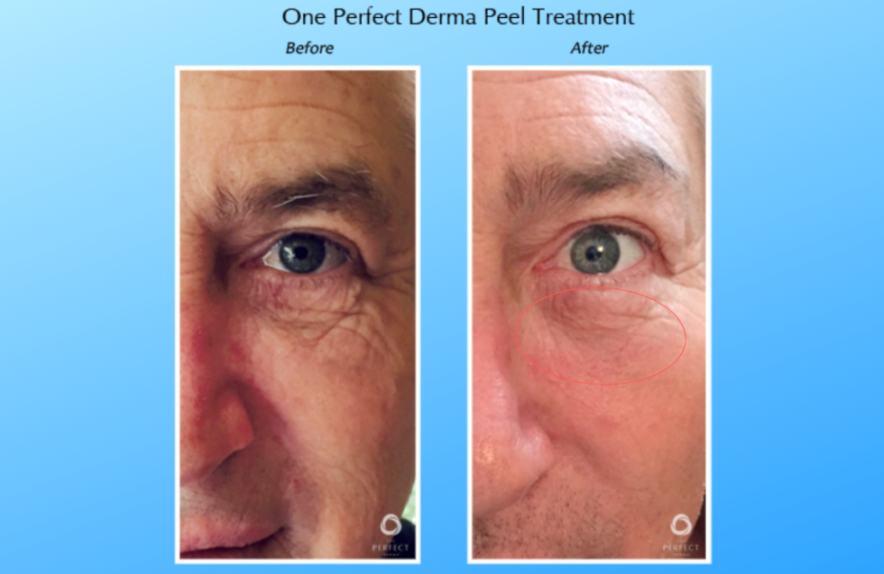 The Perfect Derma™ Peel | Advanced Skin & Body Solutions
