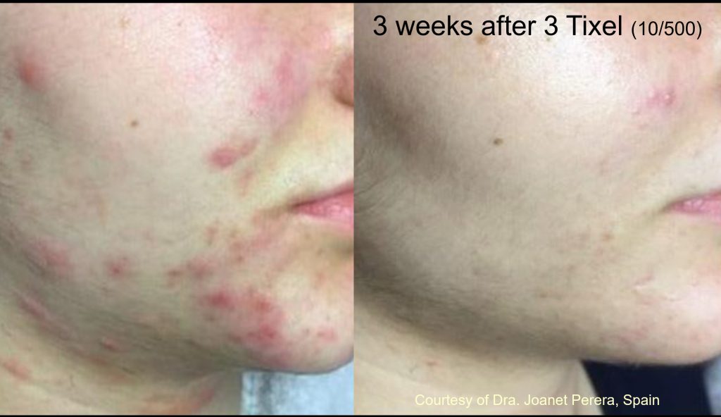 Tixel 2® | Advanced Skin & Body Solutions